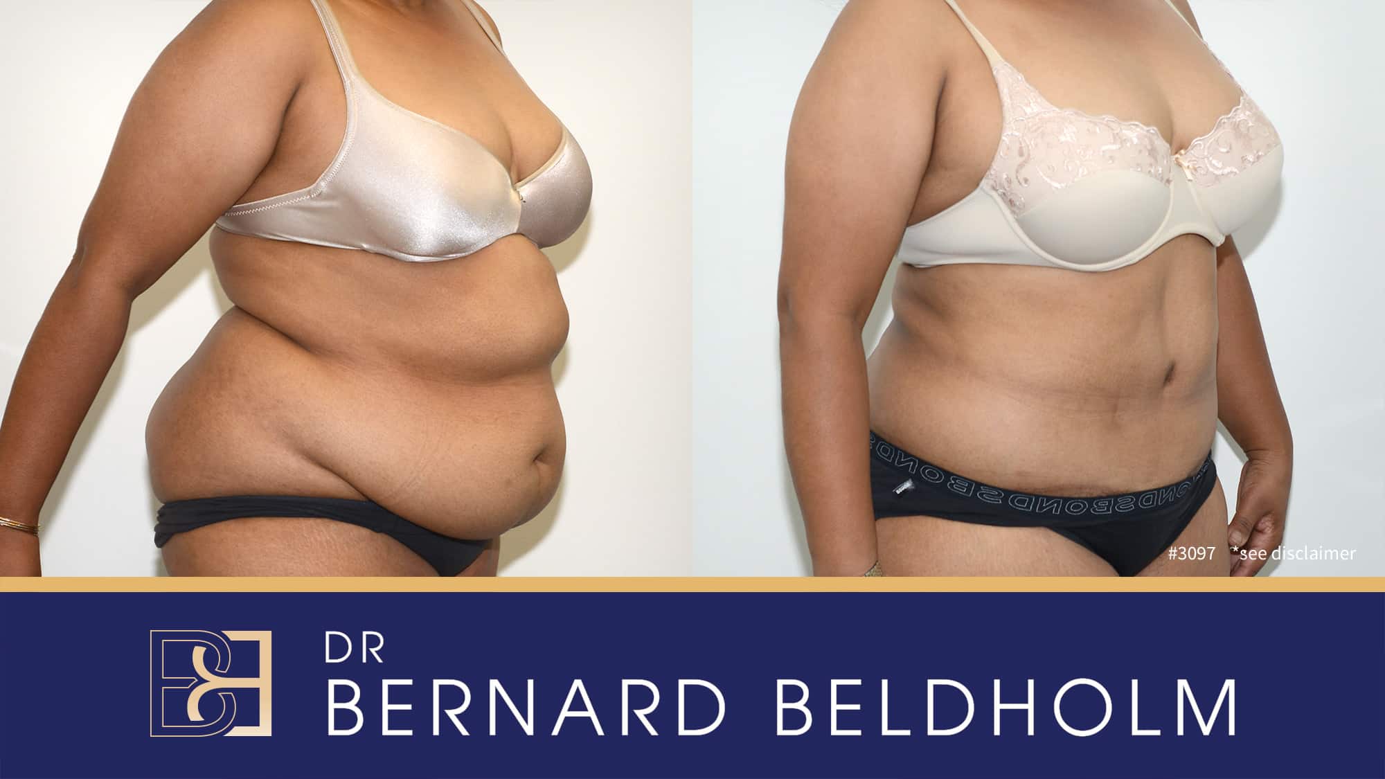 Tummy tuck post pregnancy before & after results - Cooks Hill, NSW Tummy tuck post pregnancy before & after results - Cooks Hill, NSW