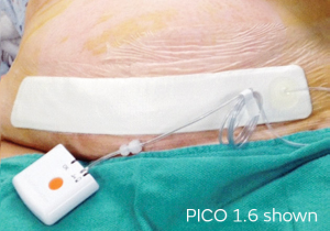 Using PICO Negative Pressure Dressings for Abdominoplasty Incision